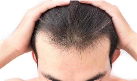 海口患有头皮白癜风如何进行头发护理？ 知乎