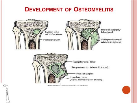 Osteomyelitis Types Clinic Features And Treatment Pptx