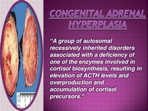 11 Beta Hydroxylase Deficiency Hyperkalemia Diet Dutoday