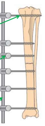 Ortho Lab 2 External Skeletal Fixation Flashcards Quizlet