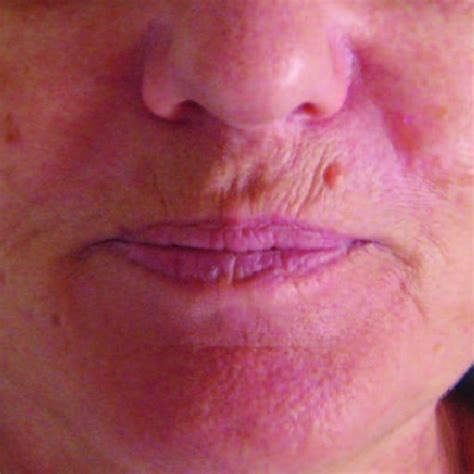 A 58 Year Old Patient With A Diffuse Cutaneous Form Of Systemic