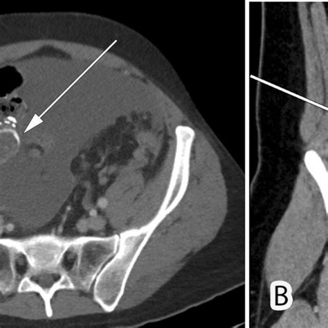 A Axial Abdominal Ct Demonstrates Dilated Appendix With Mural