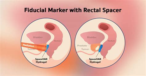 Fiducial Marker With Rectal Spacer Mens Health Thailand