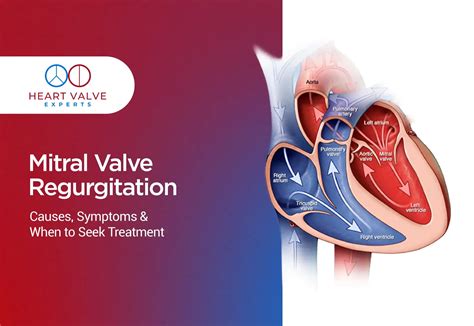 Mitral Valve Regurgitation Causes Symptoms Risk Factors And Treatment