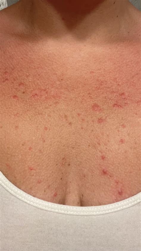 Is This Folliculitis Or Something Else Rfolliculitis