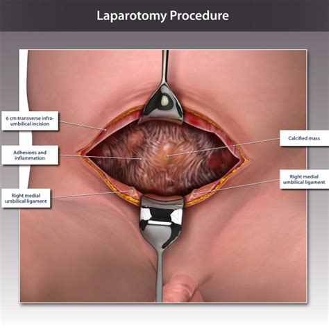 Medical Legal Exhibits Legal Animations And Trial Graphics