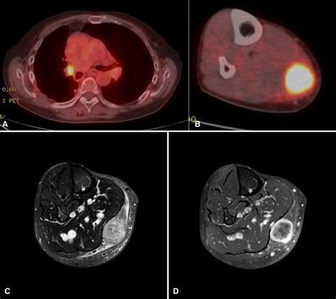 Popliteal Lymph Nodes Mri
