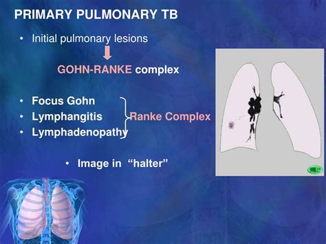 Ppt Pulmonary Tuberculosis Radiological Images Powerpoint Presentation Id 3333731