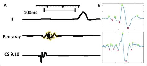 Definition Of Fractionated Atrial Electrograms The Figure Illustrates Download Scientific