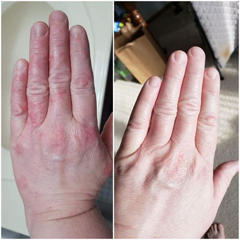 Update Patch Test Revealed Allergen R Eczema