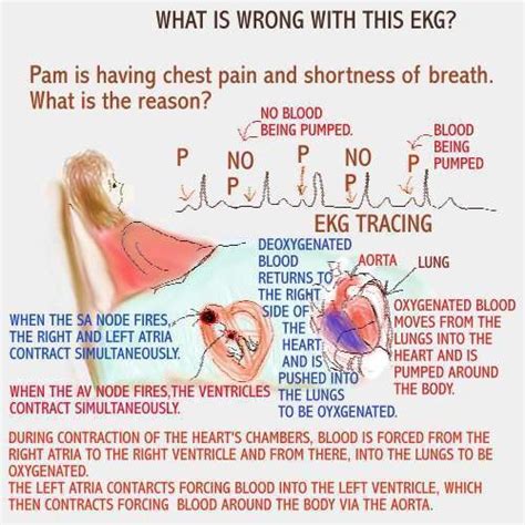 Pacemaker Implantation