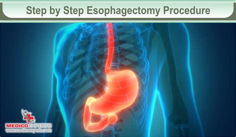Esophagectomy Surgery Procedure Risk And Benefits