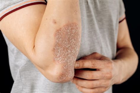 Premium Photo Acute Psoriasis On The Elbows Is An Autoimmune