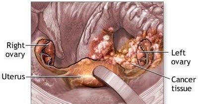 Ovarian Cancer Stages Symptoms Diagnosing Ovarian Cancer