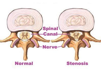 Definition Diagnosis And Treatment Of Central Canal Stenosis Fortis
