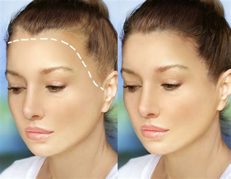 Frontal Fibrosing Alopecia How To Handle It Cosmedica