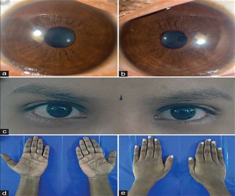 Bilateral Asymmetrical Choroidal Vitiligo Journal Of Postgraduate