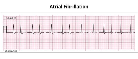 Atrial Flutter And Fibrillation Treatment In Sugar Land