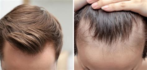 How To Style Hair With Widow S Peak 10 Easy Steps 2025