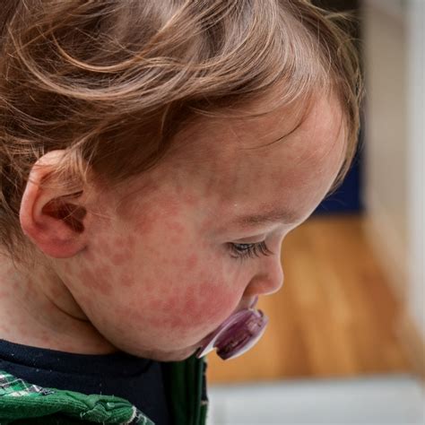 Measles Response Efforts Hindered By Misinformation Zeam Health And Wellness Psychiatry