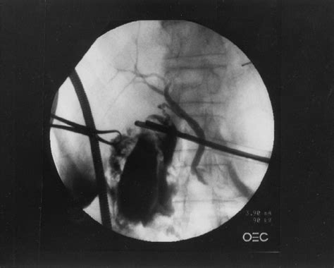 Preview Cholangiogram In The Patient With Gangrenous Gallbladder