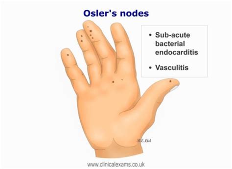 Osler Nodes Endocarditis