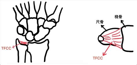 腕关节扭伤、疼痛，谨防tfcc损伤！