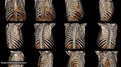 Theres No Evidence That Ct Angio Prevents Sudden Heart Attacks And