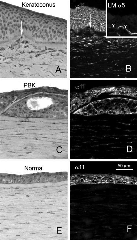 Staining Patterns In A Case Of Keratoconus A B A Case Of Pbk C D