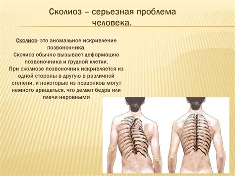 Сколиоз. Как с ним бороться? - online presentation