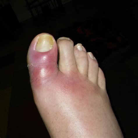 Patient Stories Orbactiv® Oritavancin For Injection