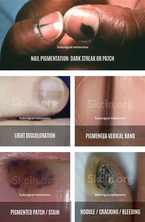 Difference Between Subungual Hematoma And Melanoma