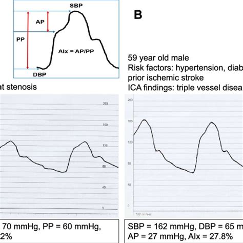 Invasively Measured Central Aortic Pressure Waveforms And Associated