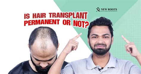 Is Hair Transplant Permanent In India Find Out The Truth
