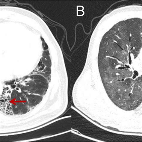 A A 59 Year Old Male Patient With Colon Cancer And Lung Metastasis Was
