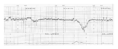 Cardiotocographic Ctg Monitoring Revealed A Late Type Of Deceleration