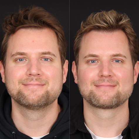 Platysmaplasty Before And After Davis Facial Plastics