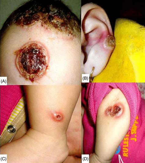 Disseminated Multiple Erythematous Vegetating Pustular Nodules And