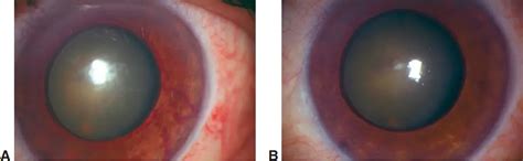 Neovascularization Of The Iris