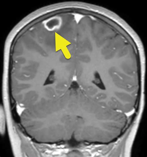 Brain Abscess Applied Radiology