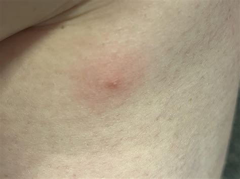 Just A Pimple Or Mrsa Rdiagnoseme