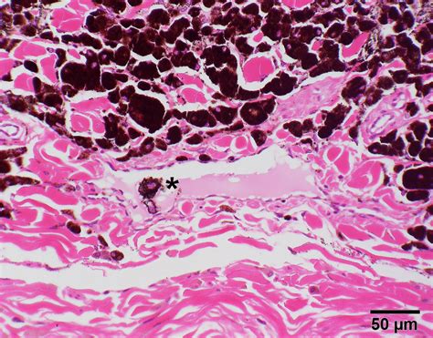 Photomicrograph Of Dermal Mass Consisting Of Heavily Pigmented