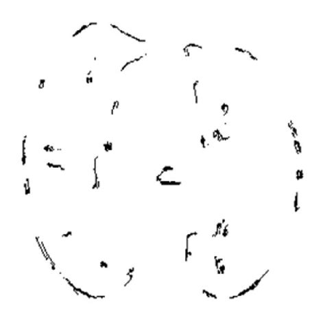 A Input Lung Ct Image B Otsu Output Image C Watershed Output Download Scientific