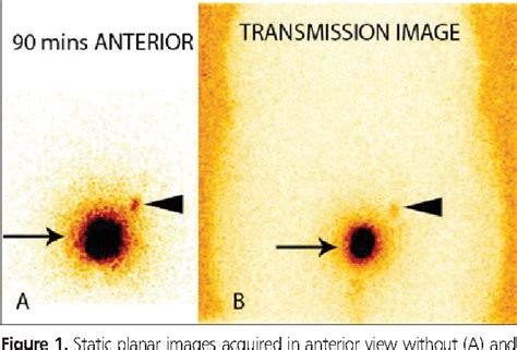 Figure From Utility Of SPECT CT In Sentinel Lymph Node Detection In A Case Of Vulvar Carcinoma