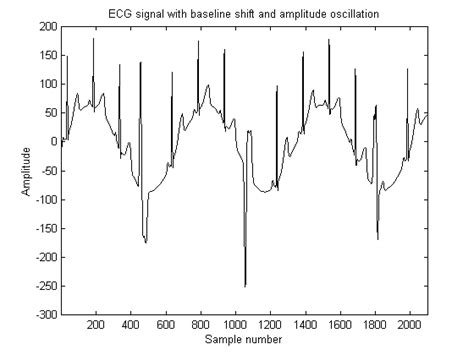 Qrs Detection Ecg With Baseline Shift And Amplitude Oscillation Figure
