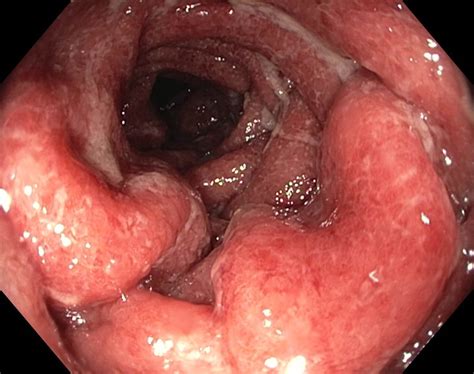Colonoscopy Pictures Of Ulcerative Colitis