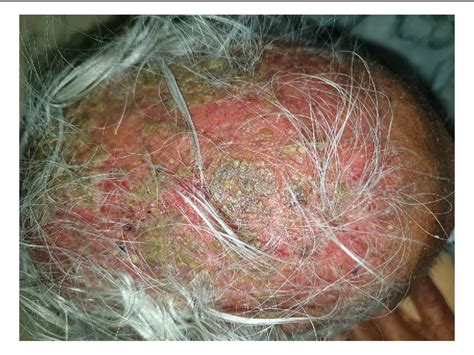 Figure 1 From Erosive Pustular Dermatosis Of The Scalp Secondary To