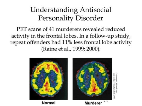 Antisocial Personality Disorder Brain Vs Normal Brain