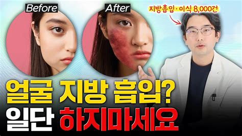 얼굴지방흡입 부작용 이거 모르시면 제발 받지 마세요 필수시청 Youtube