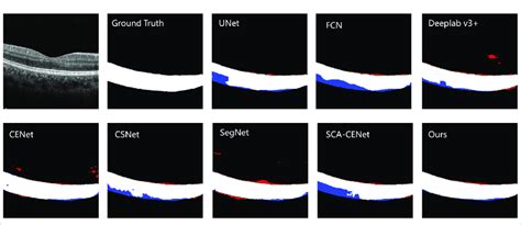 The Visualization Of The Example Result Of Choroid Segmentation On The